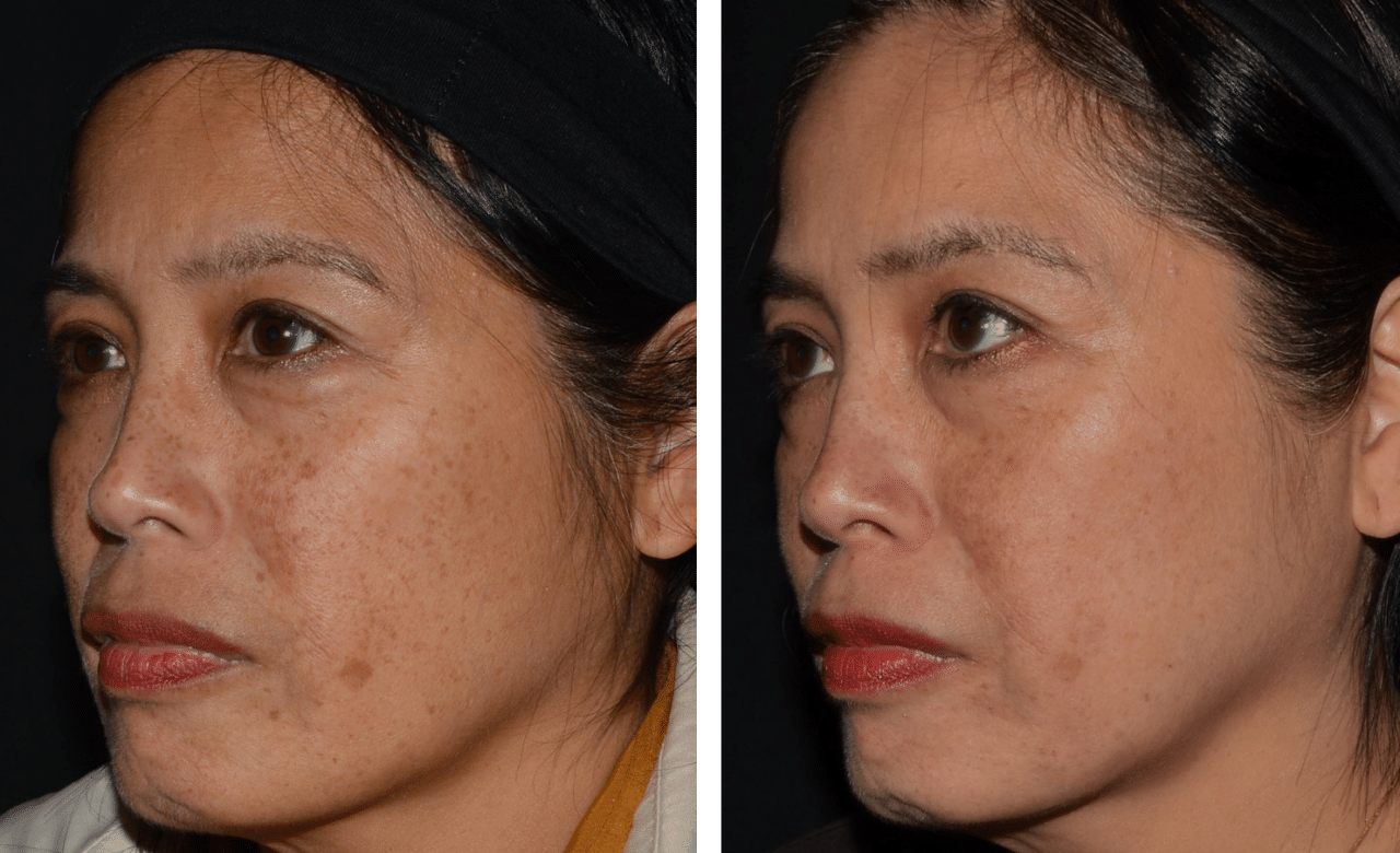 LaseMD Ultra Treatment in Englewood Cliffs | Scherl Dermatology